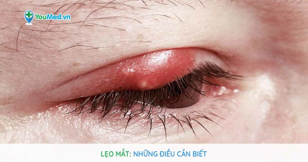 Top 3 thuốc nhỏ mắt trị mụt lẹo (lẹo mắt) tốt hiện nay