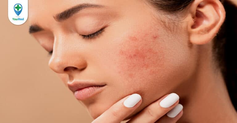 Thuốc Rhumenol Flu 500: Công dụng, cách dùng và lưu ý