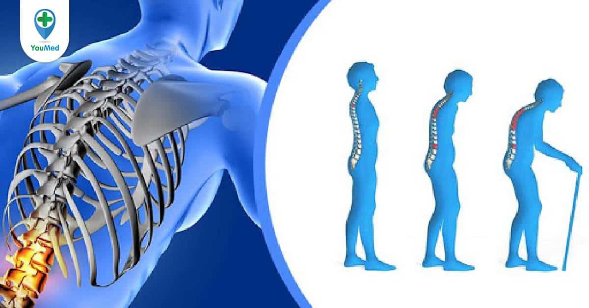 Loãng xương ở người già và phân loại các cấp độ bệnh