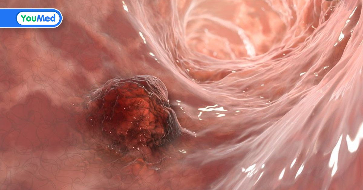 Ung thư đại tràng giai đoạn 1: Triệu chứng và cách điều trị